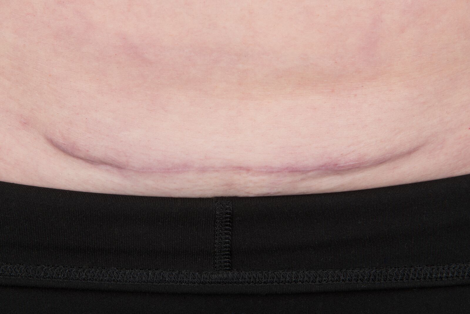 Before & After - Alliance Kelo Cote