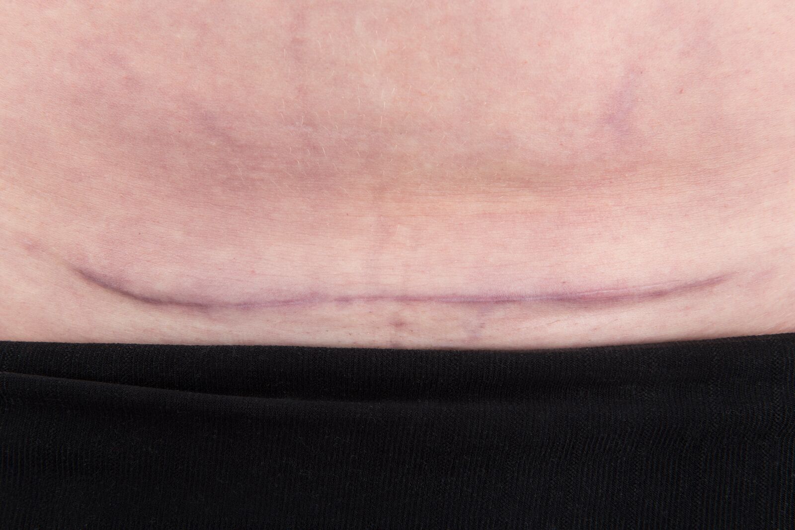 Before & After - Alliance Kelo Cote