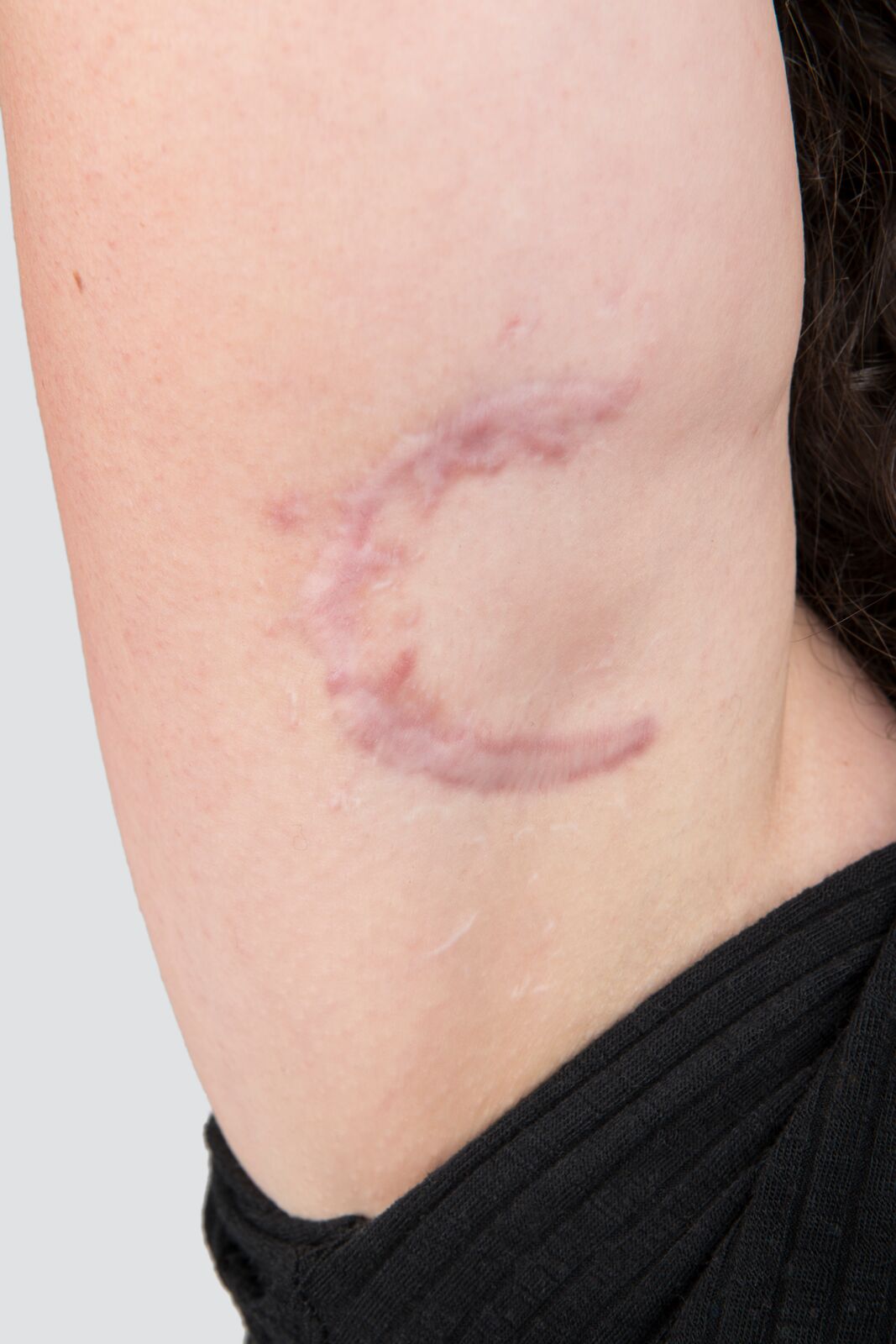 Before & After - Alliance Kelo Cote