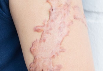 Hypertrophe Narben, Keloide - KELO-COTE® Narbenbehandlung