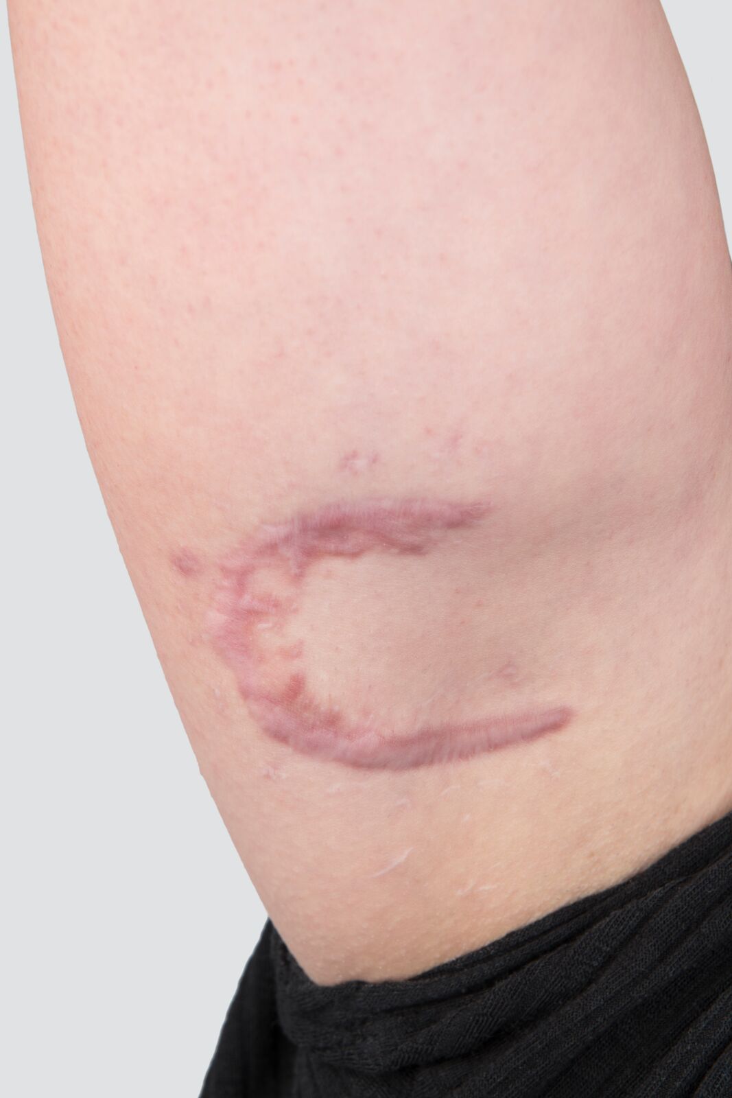 Before & After - Alliance Kelo Cote